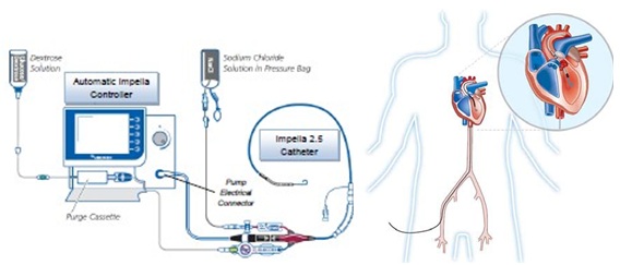 FDA Approves Abiomed Impella Blood-Pump System for Cardiac Surgery ...